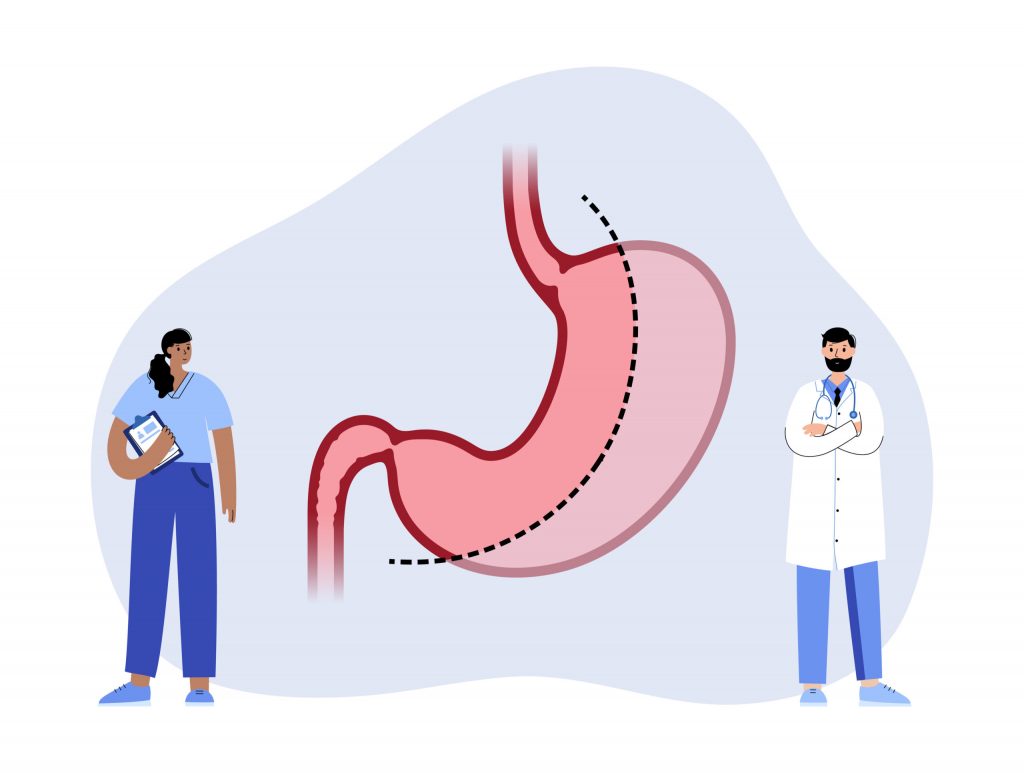 Gastric Sleeve Revision Surgery - Sleeve Turkey